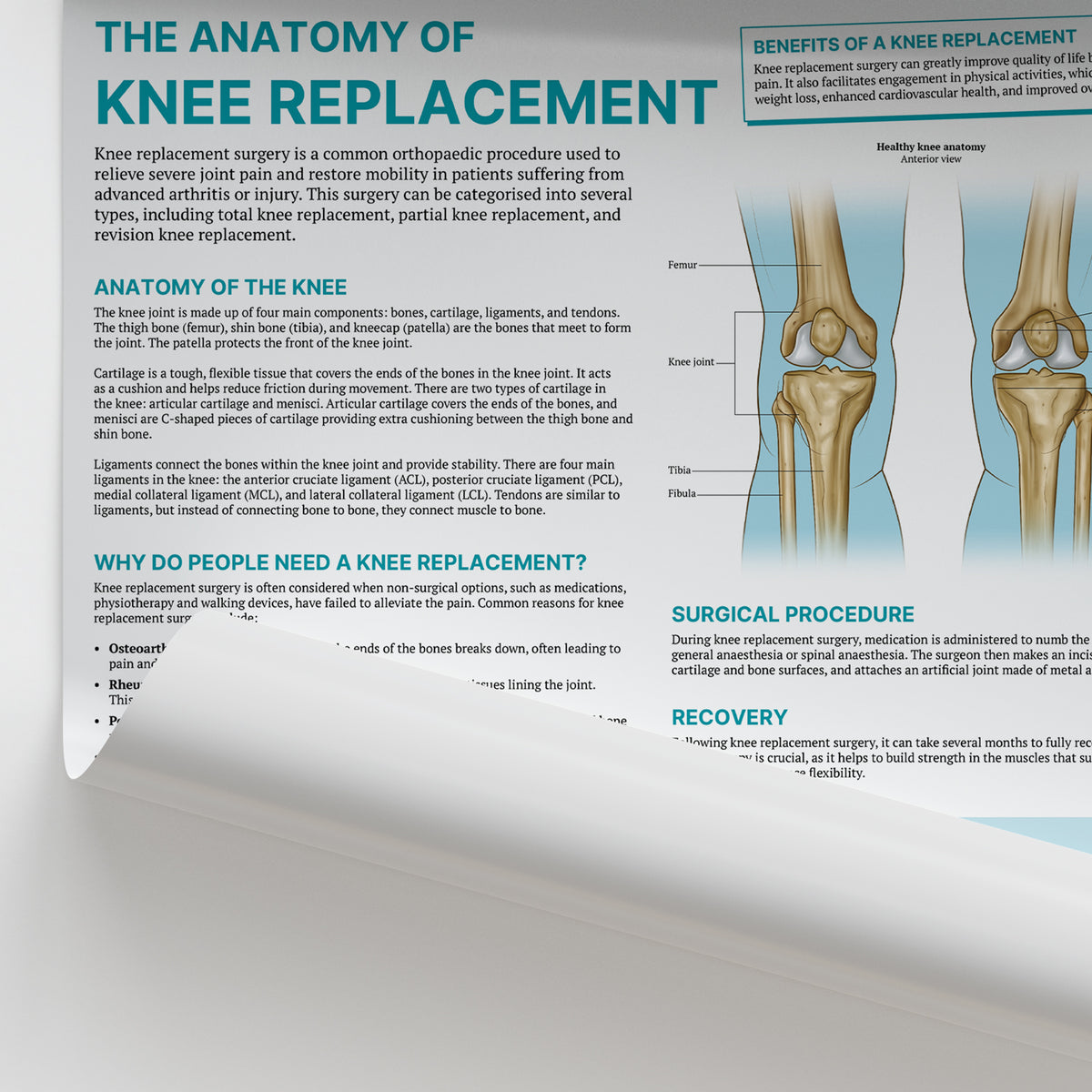 Knee Replacement Anatomy Poster | Surgical Procedure & Recovery Chart ...