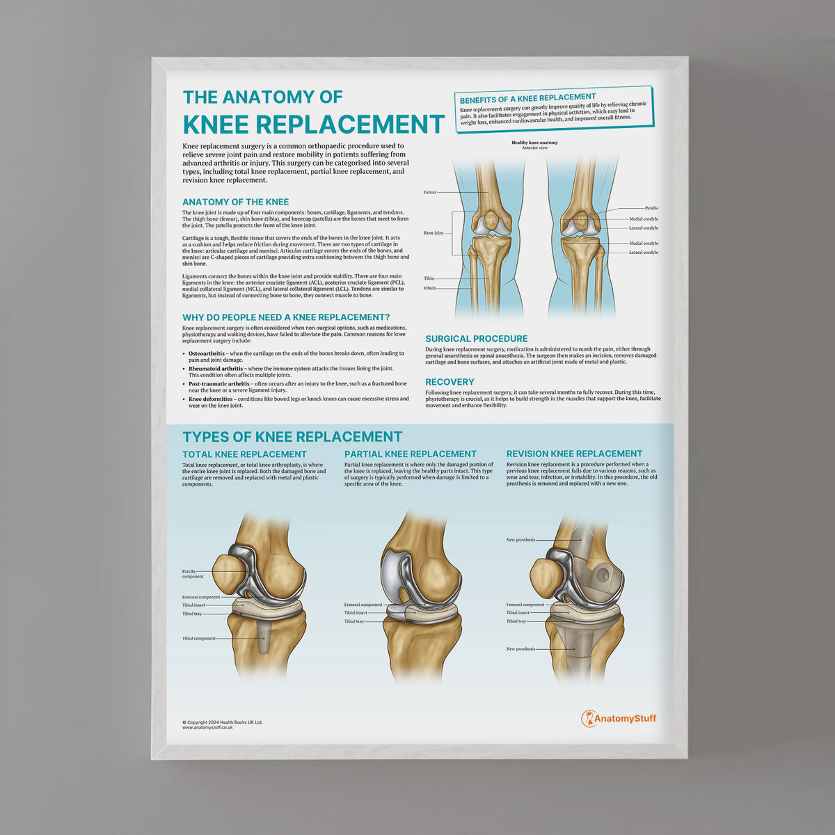 Knee Replacement Anatomy Poster | Surgical Procedure & Recovery Chart ...