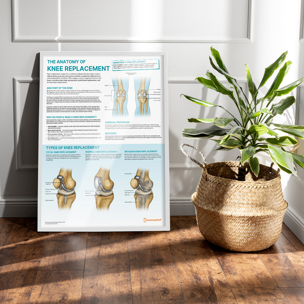 Knee Replacement Anatomy Poster | Surgical Procedure & Recovery Chart ...