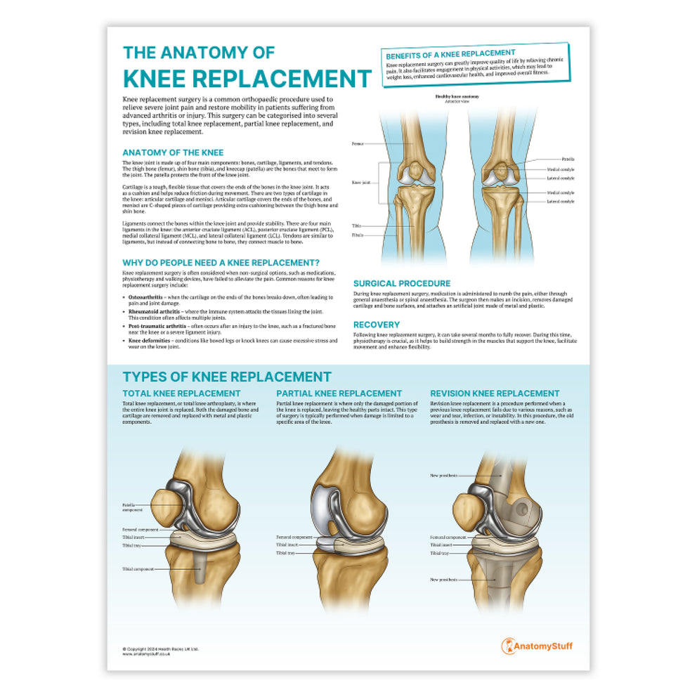 Knee Replacement Anatomy Poster | Surgical Procedure & Recovery Chart ...