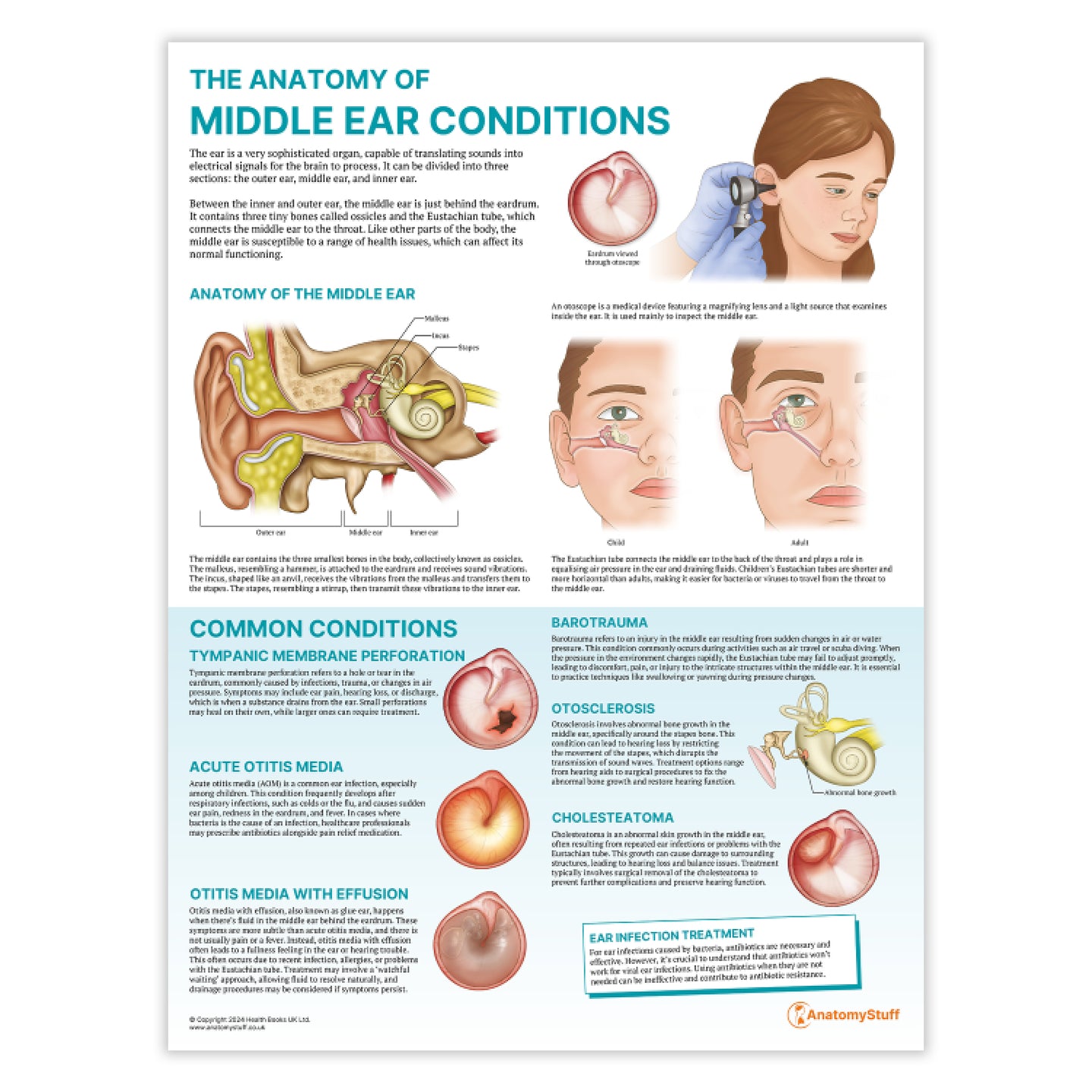 The Anatomy of Middle Ear Conditions Poster | ENT Education – AnatomyStuff