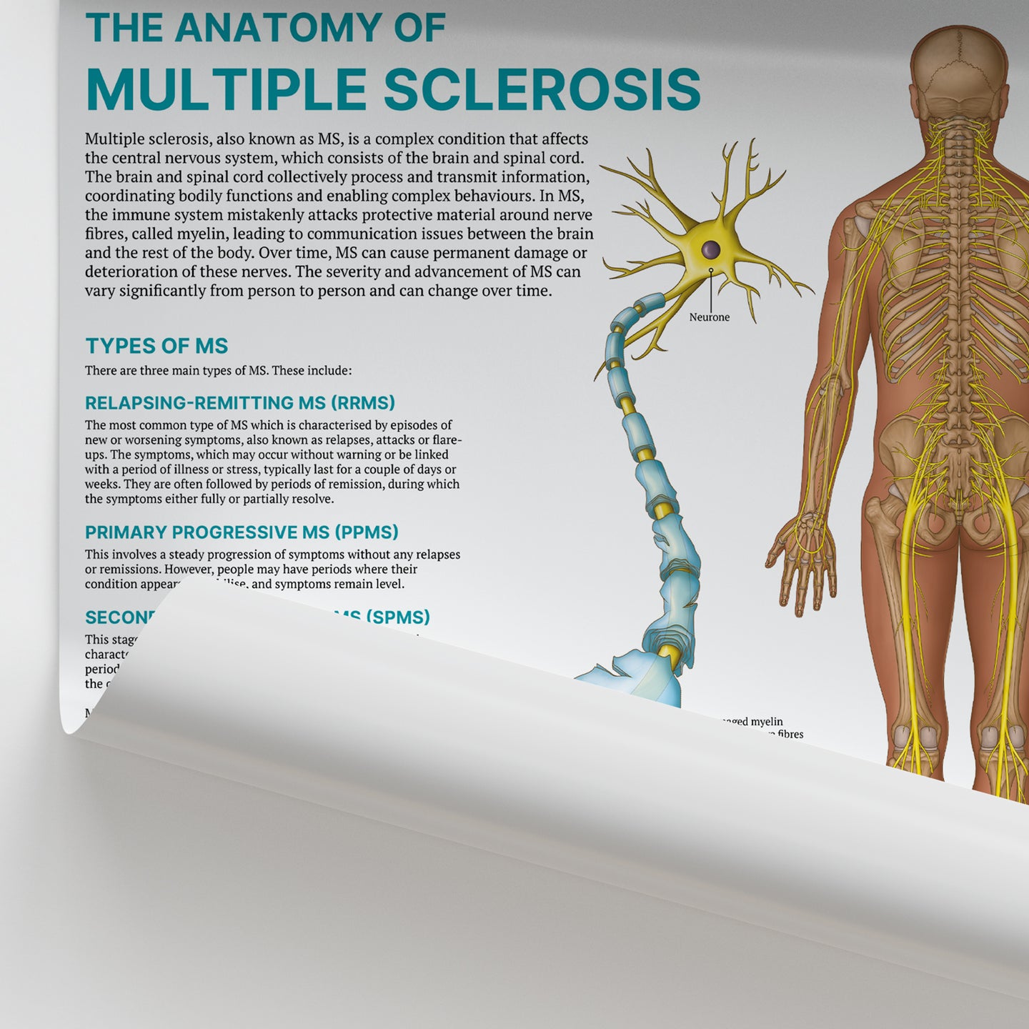 The Anatomy of Multiple Sclerosis Poster | Neurology Patient Education ...