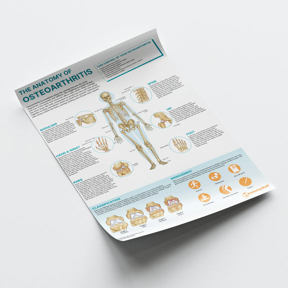 The Anatomy of Osteoarthritis Poster | OA Chart for Joint Conditions ...