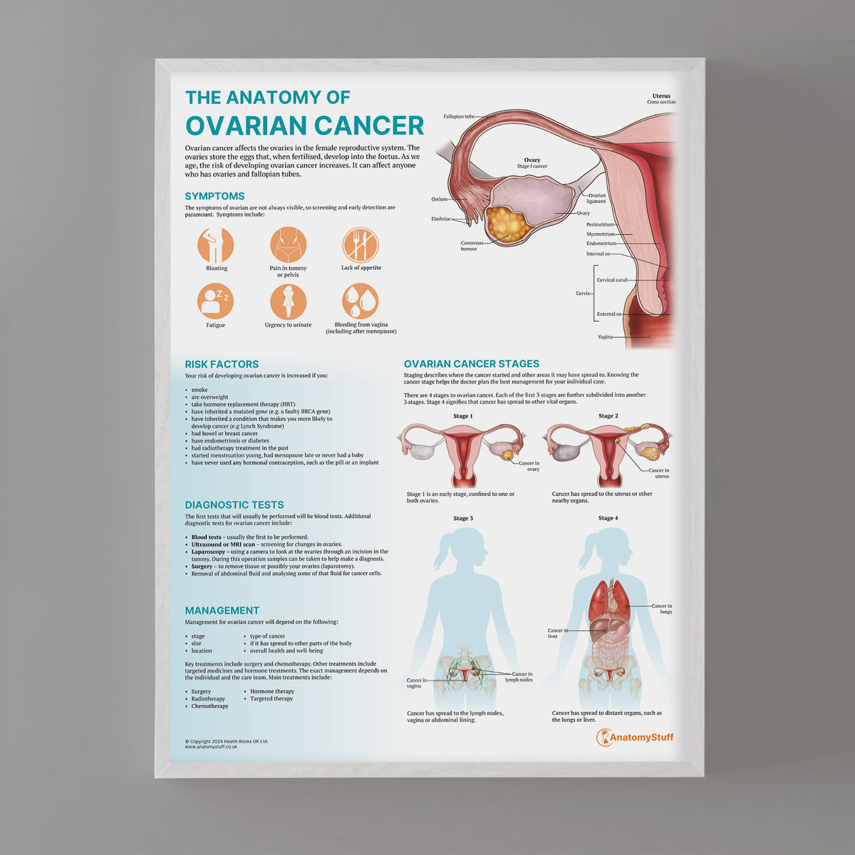 The Anatomy of Ovarian Cancer Poster | Gynaecological Cancer Chart ...