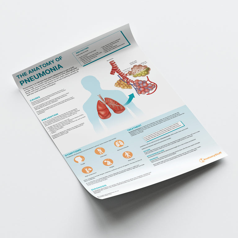 The Anatomy of Pneumonia Poster | Respiratory Infection Education Chart ...