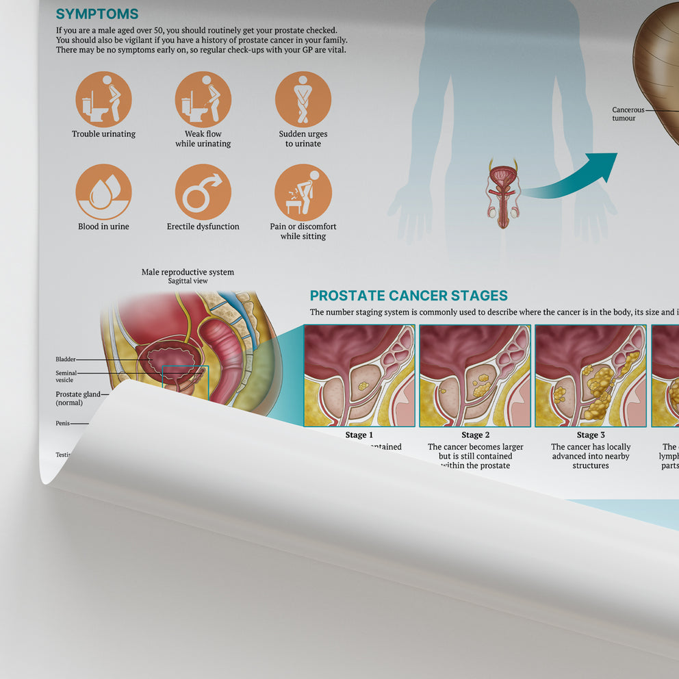 The Anatomy of Prostate Cancer Poster | Male Health Education Chart ...