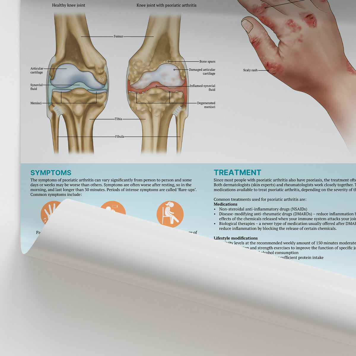 The Anatomy of Psoriatic Arthritis Poster | Joint Health & Dermatology ...