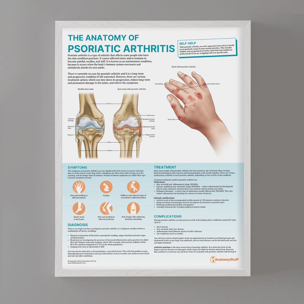 The Anatomy of Psoriatic Arthritis Poster | Joint Health & Dermatology ...