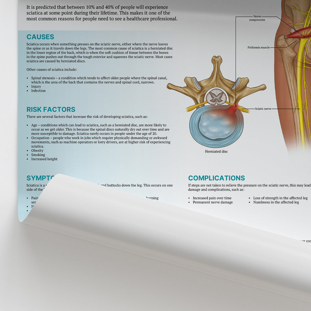 The Anatomy of Sciatica Poster | Nerve Pain & Spine Chart – AnatomyStuff
