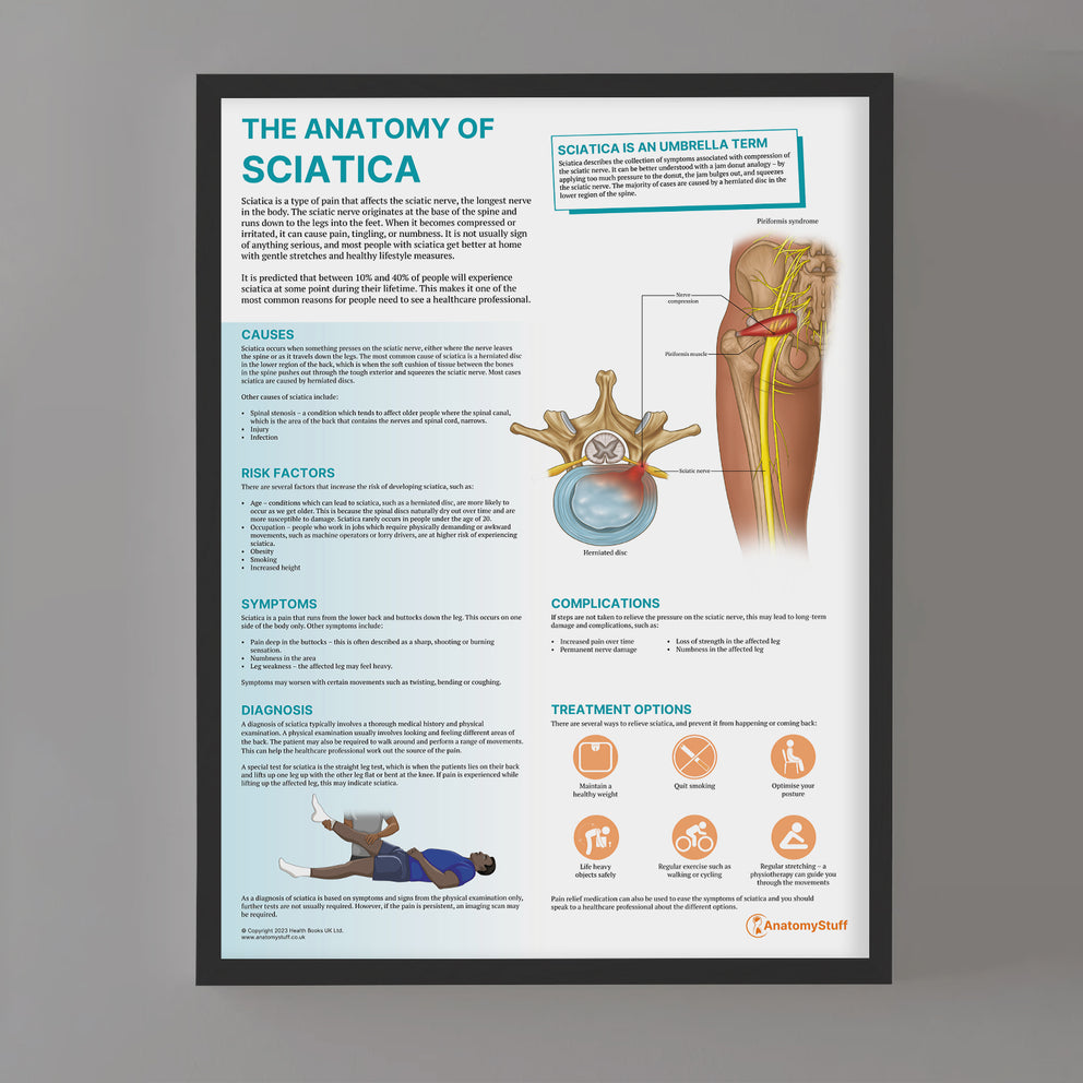 The Anatomy of Sciatica Poster | Nerve Pain & Spine Chart – AnatomyStuff