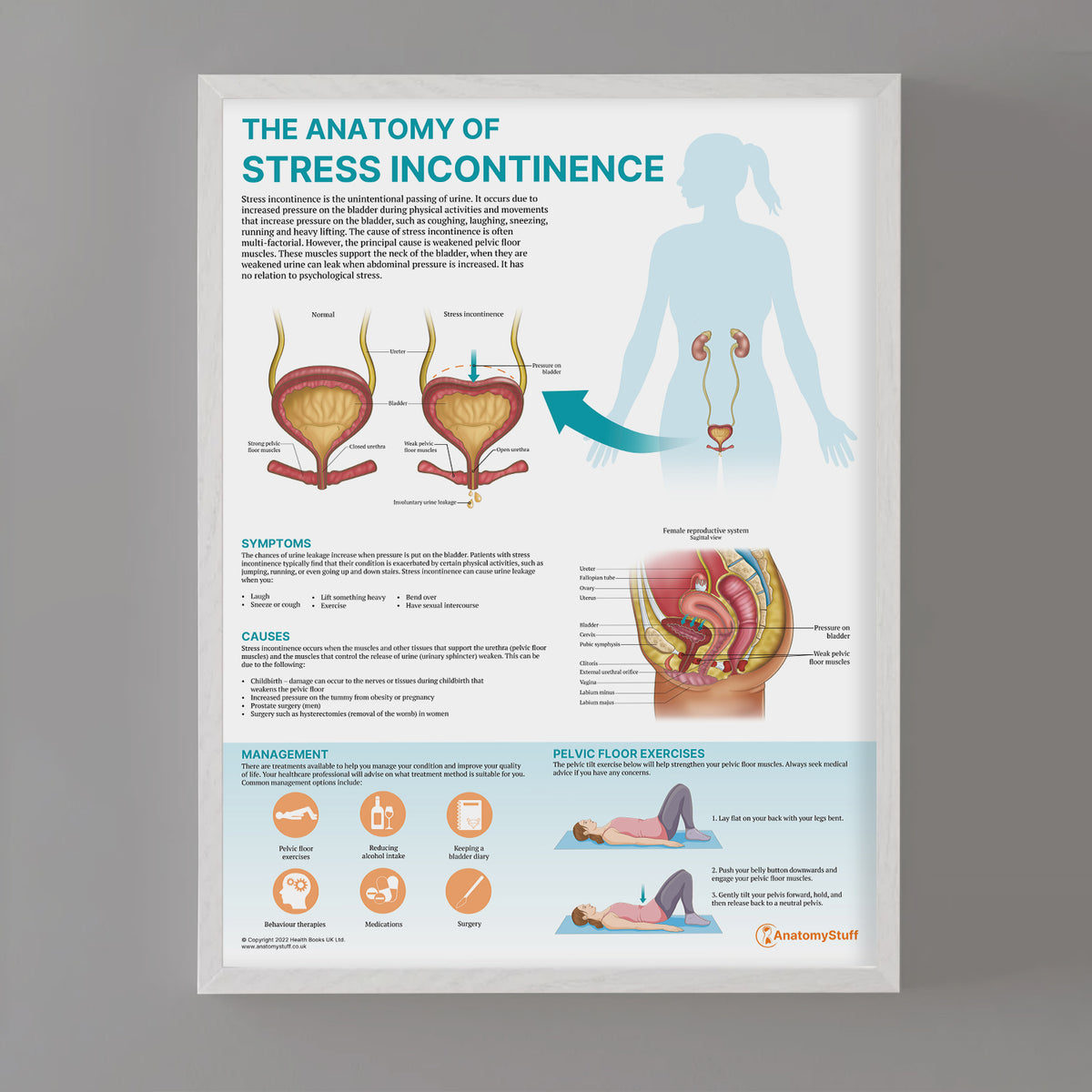Anatomy of Stress Incontinence Chart | Urology Poster | AnatomyStuff