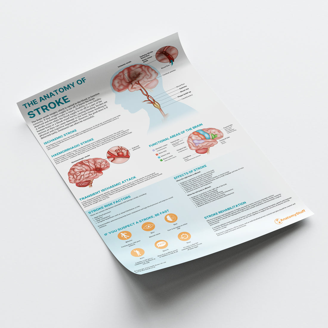 Stroke Brain Poster | Types, Effects & Treatment Education | AnatomyStuff