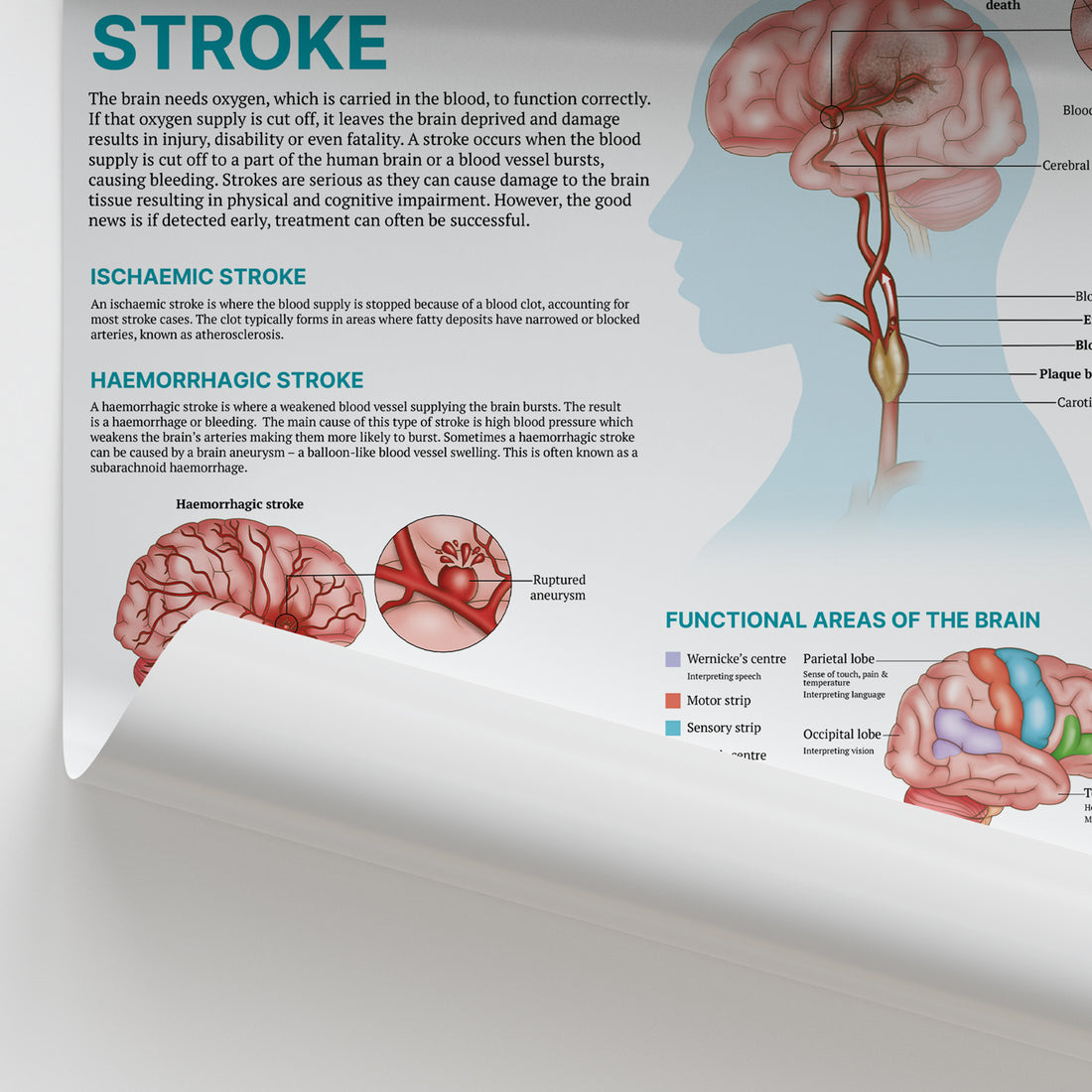 Stroke Brain Poster | Types, Effects & Treatment Education | AnatomyStuff