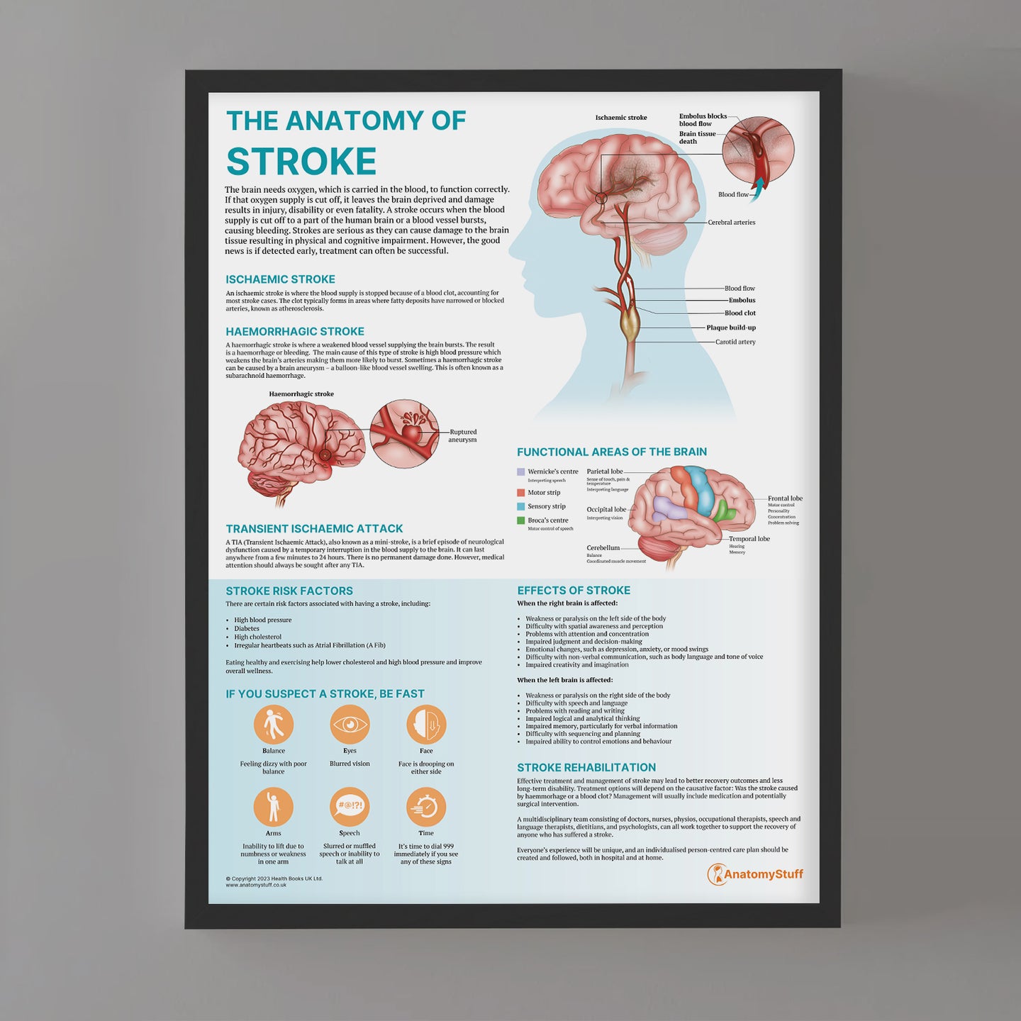 Stroke Brain Poster | Types, Effects & Treatment Education | AnatomyStuff
