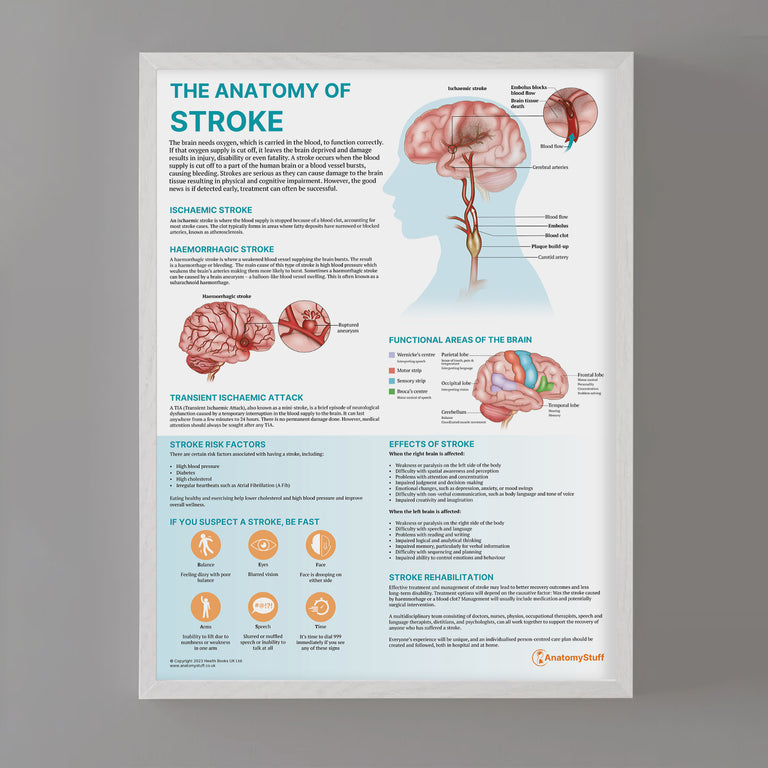 Stroke Brain Poster | Types, Effects & Treatment Education | AnatomyStuff