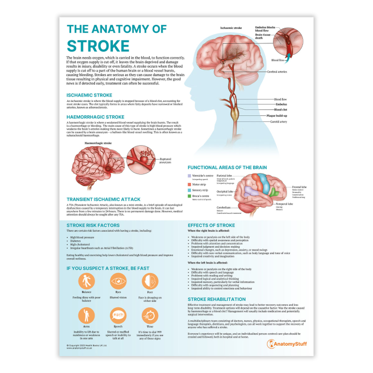Stroke Brain Poster | Types, Effects & Treatment Education | AnatomyStuff