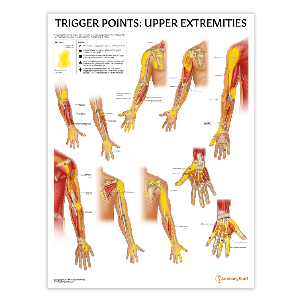 Trigger Points: Upper Extremities Poster | Shoulder, Elbow, Hand Pain ...